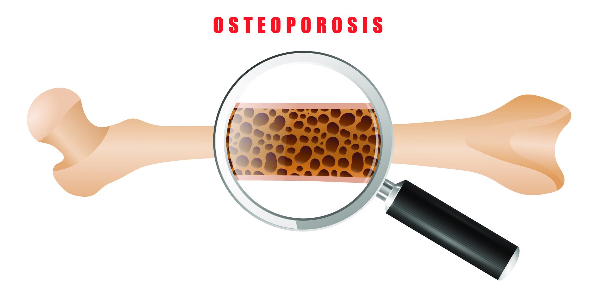 Osteoporosis: Causes and Management Injury Management